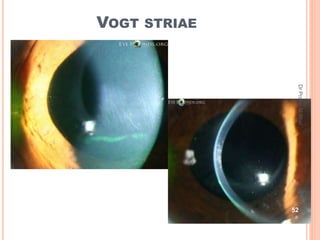 Vogts Striae
