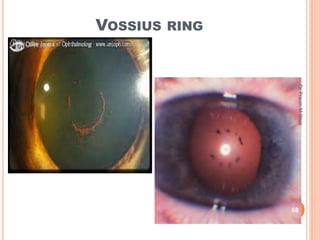 Vossius Ring
