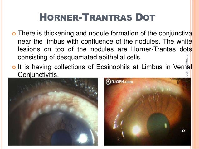 Dots spots lines and rings in ophthalmology