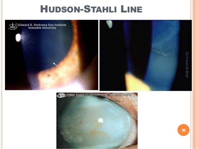 Hudson Stahli Line Bilateral, Anterior Stromal Ring Opacity Of The