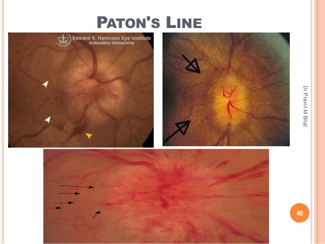 Dots spots lines and rings in ophthalmology