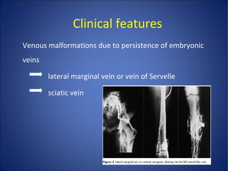 Recurrence of Klippel-Trenaunay syndrome symptoms after surgery: a ...