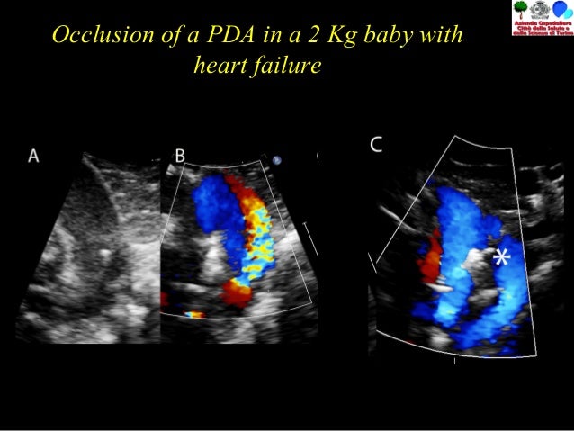 Dotto di botallo pervio