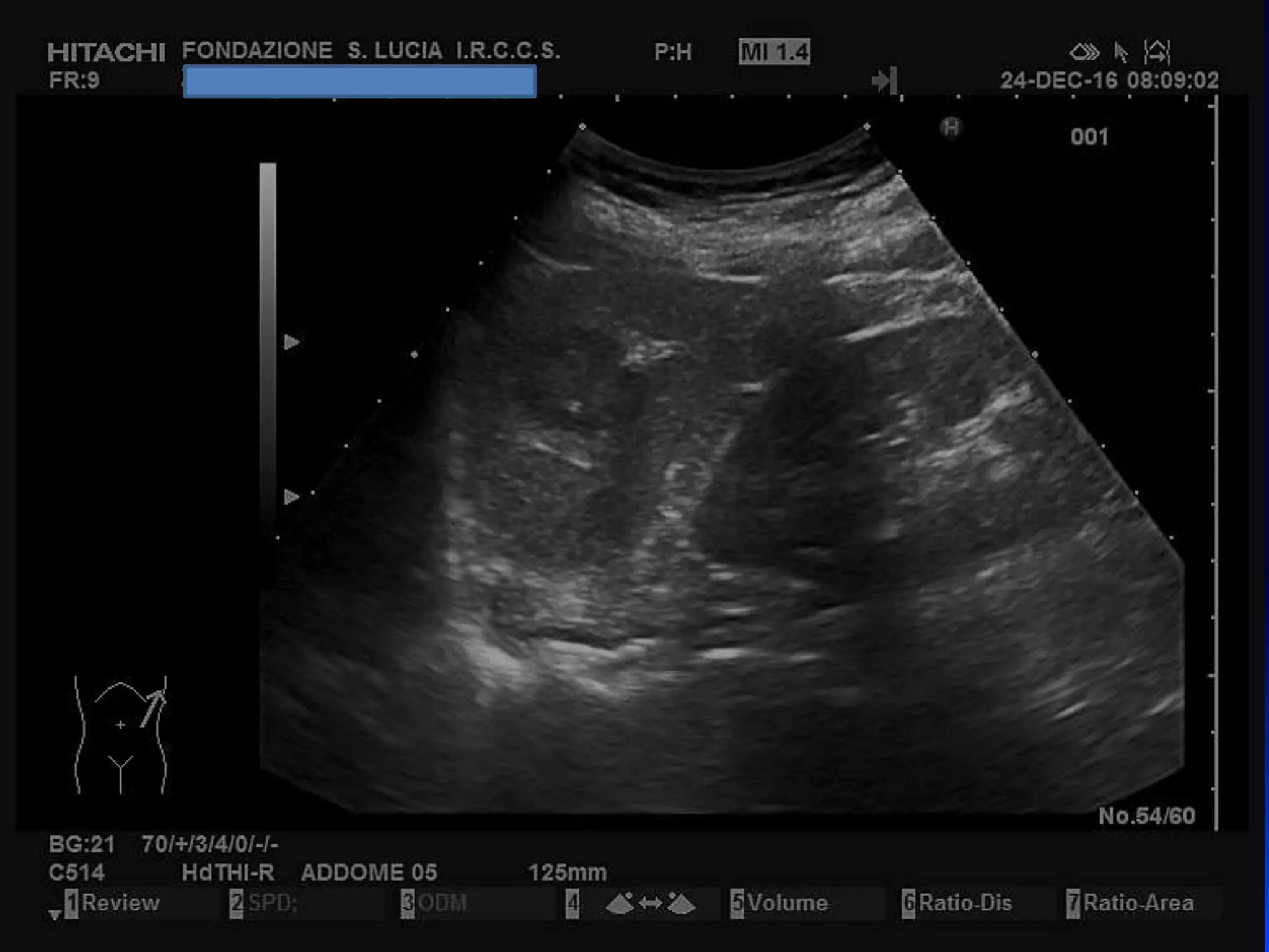 Ecografia alla milza | PPTX