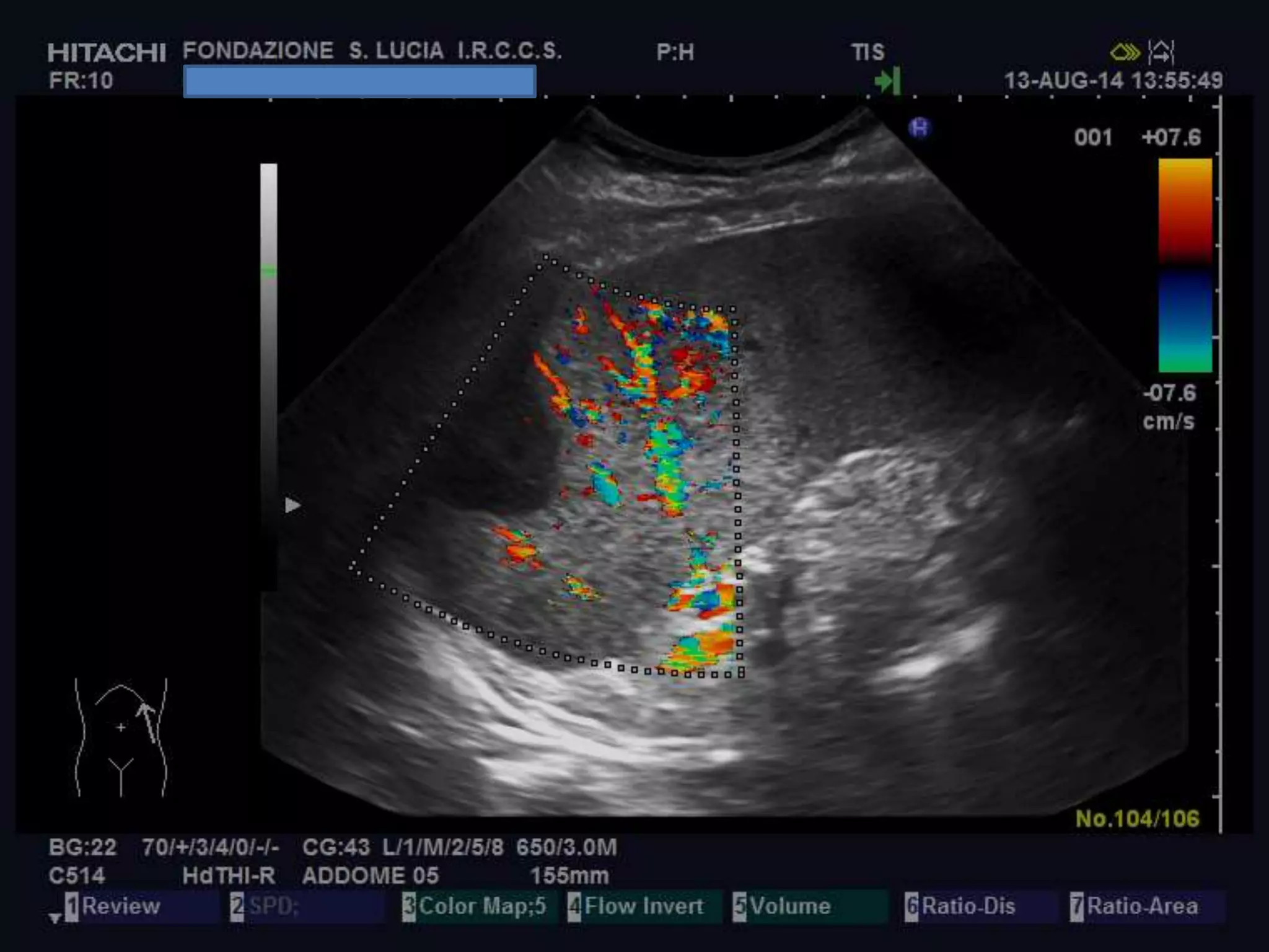 Ecografia alla milza | PPTX