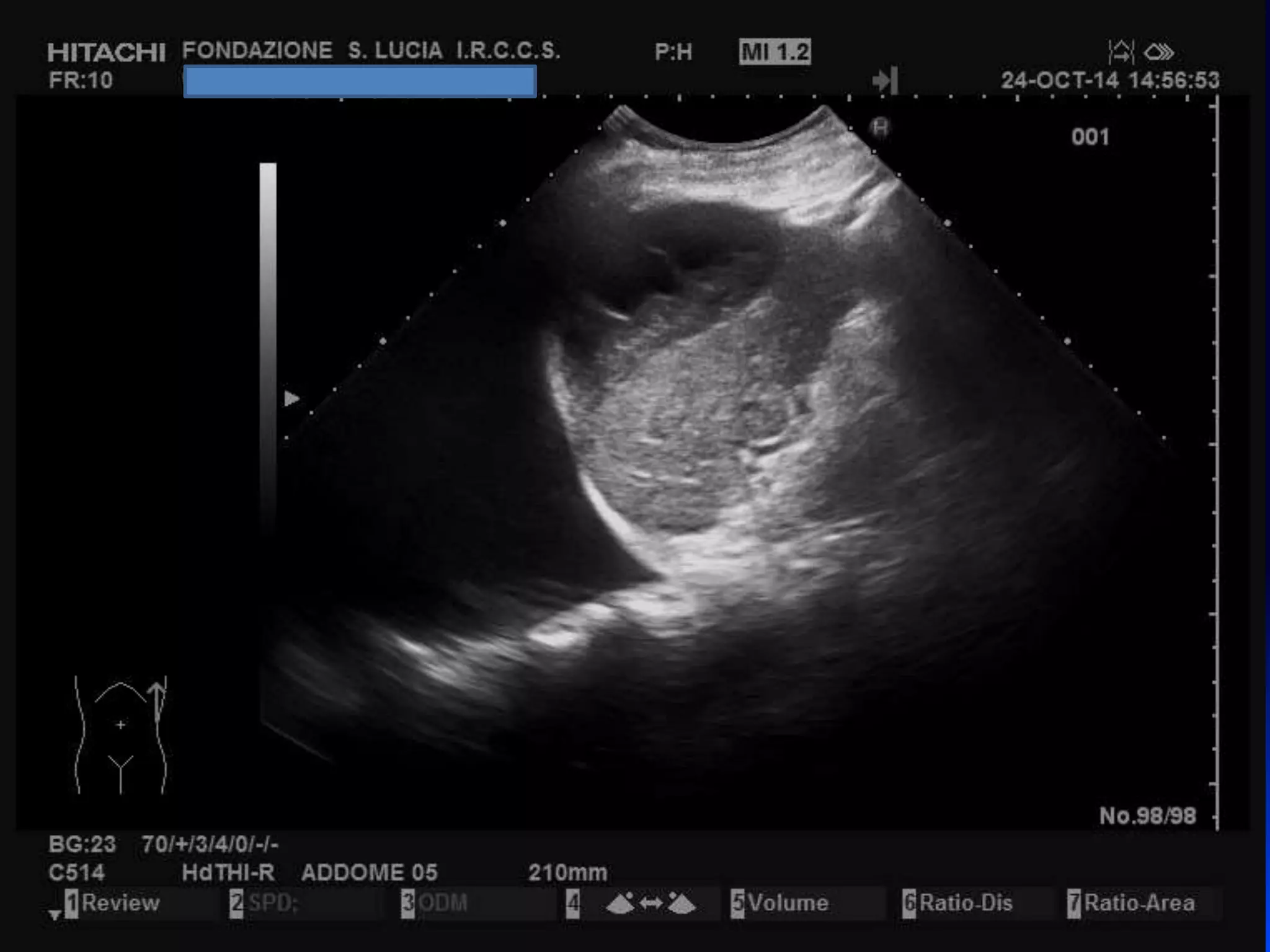 Ecografia alla milza | PPTX