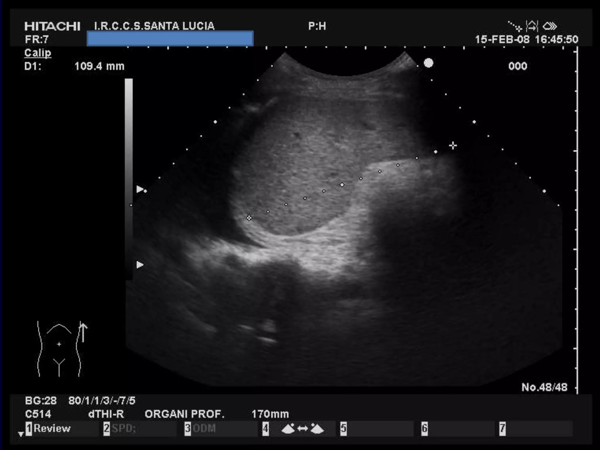 Ecografia alla milza | PPTX