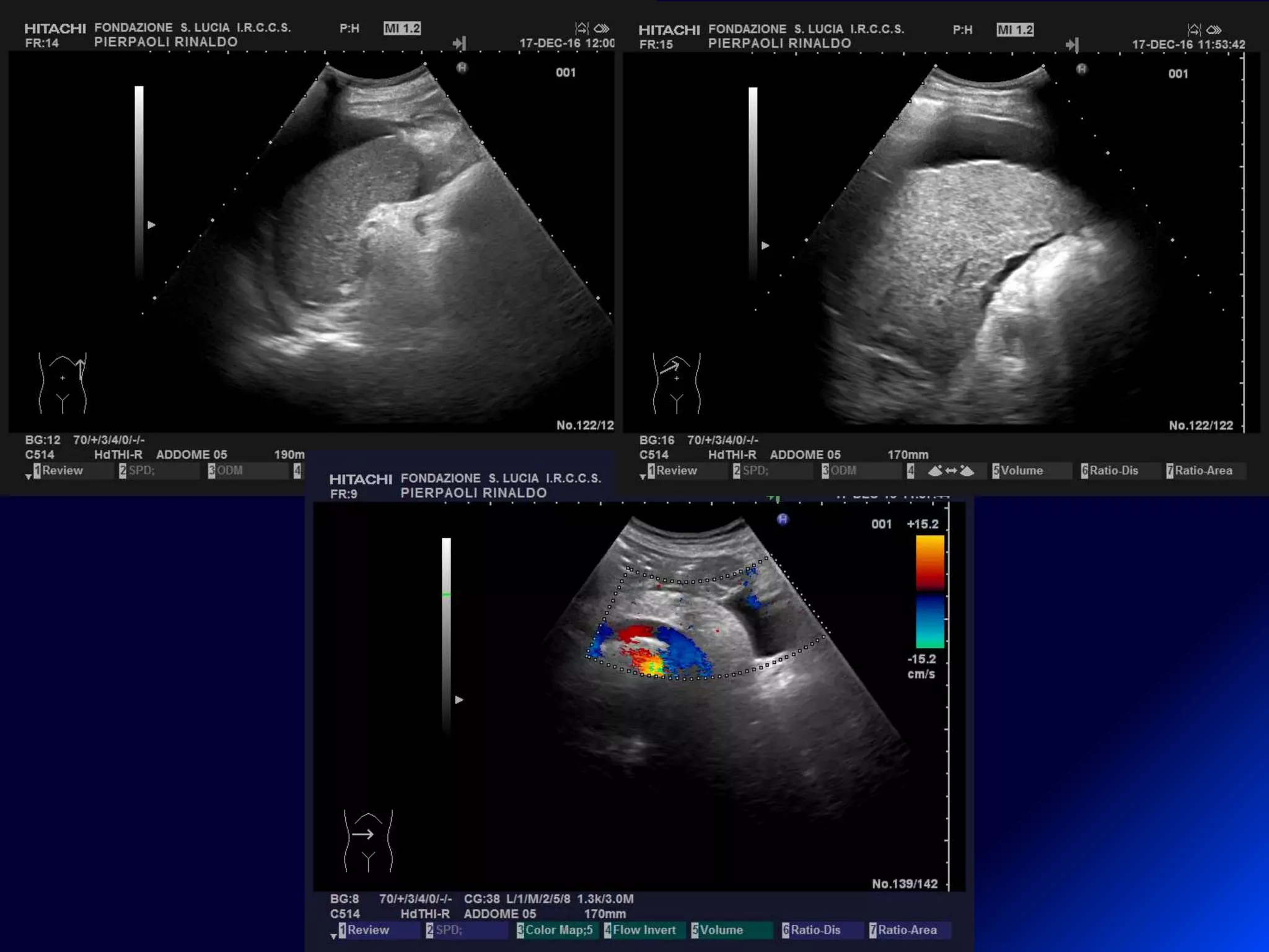 Ecografia alla milza | PPTX