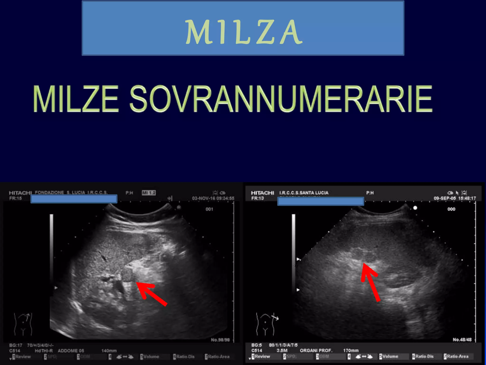 Ecografia alla milza | PPTX