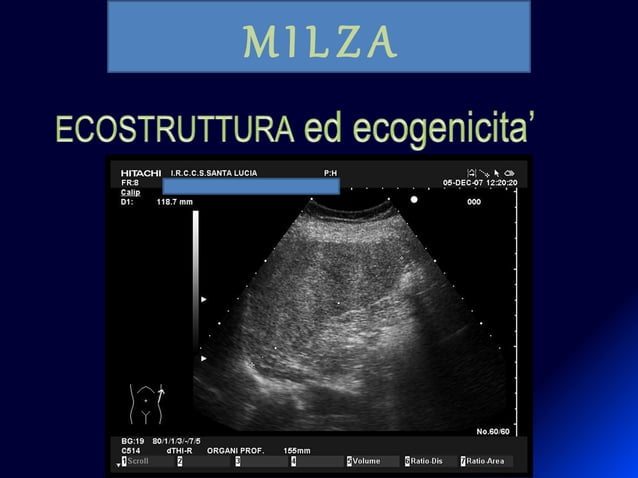 Ecografia alla milza | PPTX