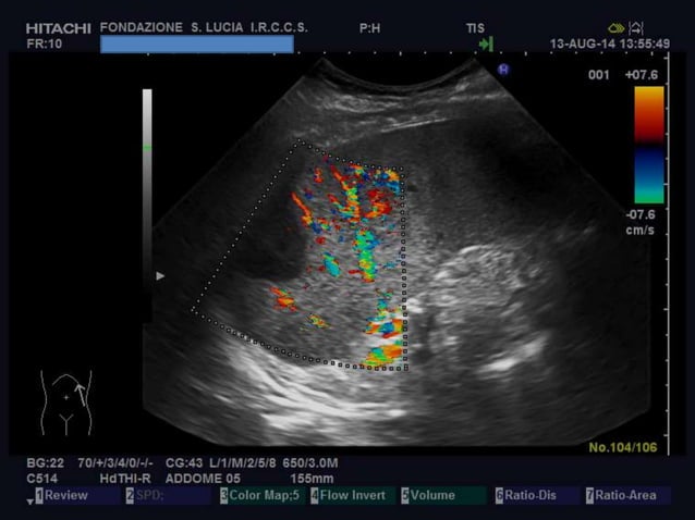 Ecografia alla milza | PPTX
