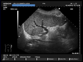 Milza Di Dimensioni Normali