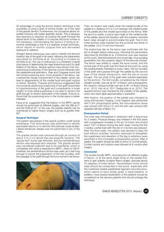 Double Bundle Medial Patellofemoral Ligament Reconstruction | PDF