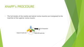 double elevator palsy with examination in | PPT