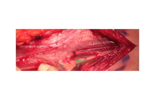 Double fascicular transfer for elbow flexion | PPTX