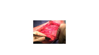 Double fascicular transfer for elbow flexion | PPTX