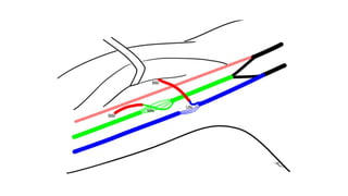 Double fascicular transfer for elbow flexion | PPTX