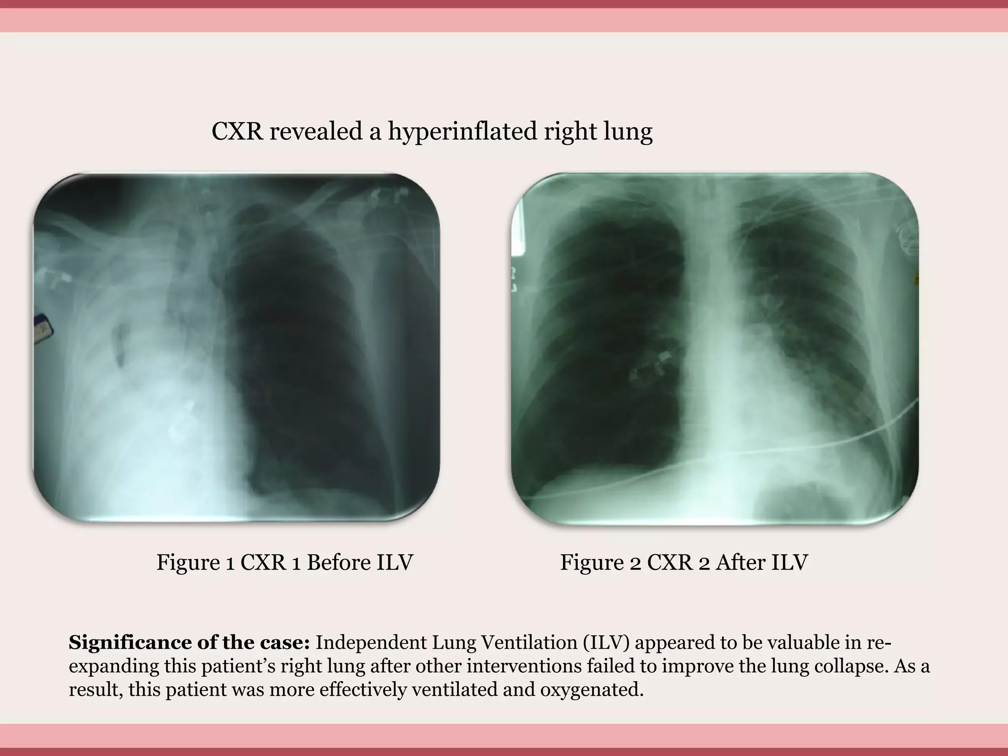 Double lung ventilation | PPT