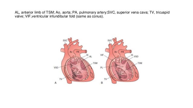 Double outlet right ventricle