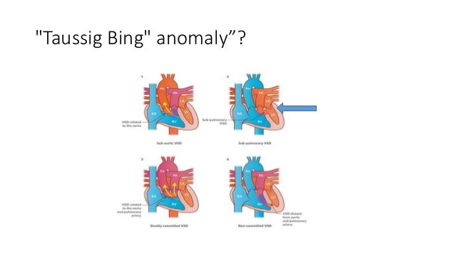 Double outlet right ventricle