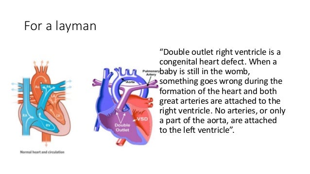 Double outlet right ventricle