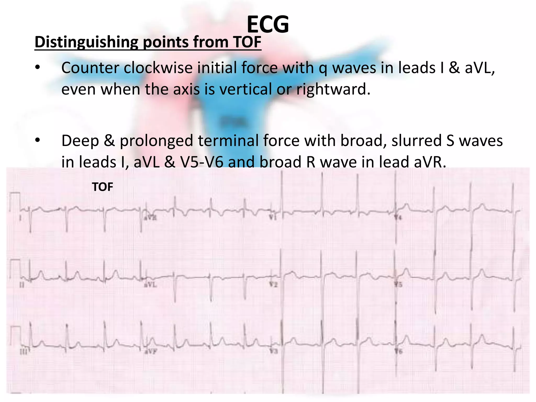 Double outlet right ventricle | PPTX