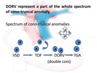 Double outlet right ventricle | PPTX