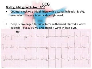 Double outlet right ventricle | PPTX