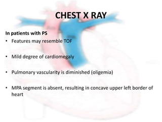 Double outlet right ventricle | PPTX