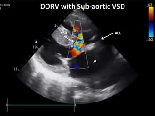 Double outlet right ventricle | PPTX