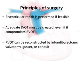 Double outlet right ventricle | PPTX