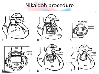 Double outlet right ventricle | PPTX