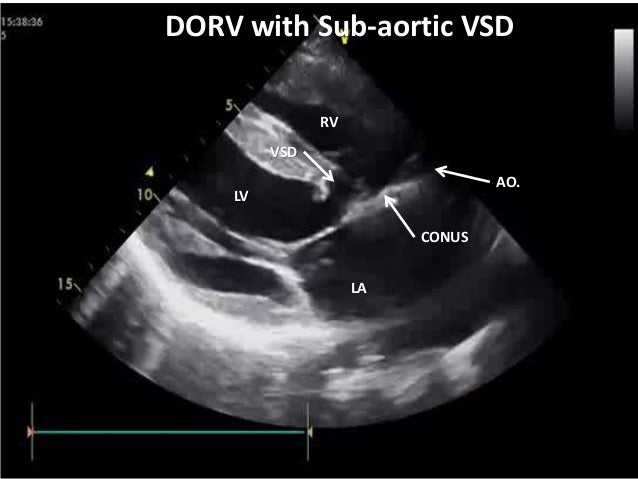 Double outlet right ventricle