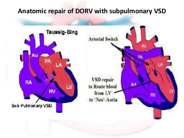 Double outlet right ventricle