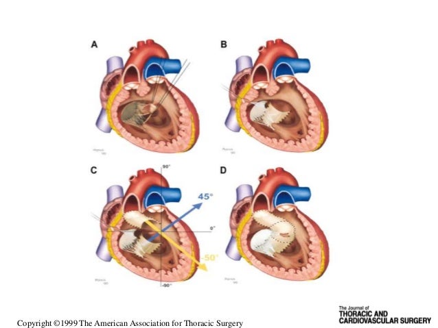 Double outlet right ventricle
