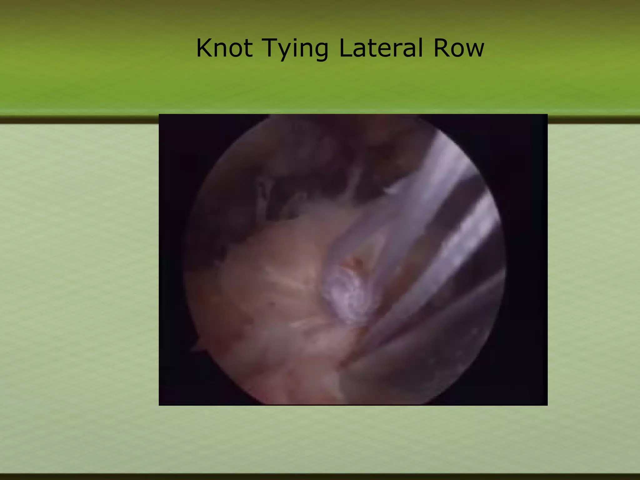 Double row repair | PPT
