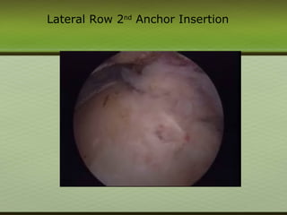 Double row repair | PPT