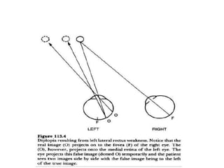 Diplopia- Double vision | PPTX