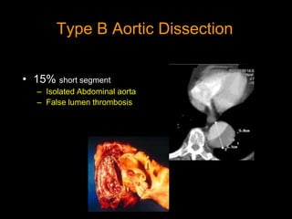 Acute Aortic Syndromes: Vascular Radiologist Point of View - Pr Ph ...
