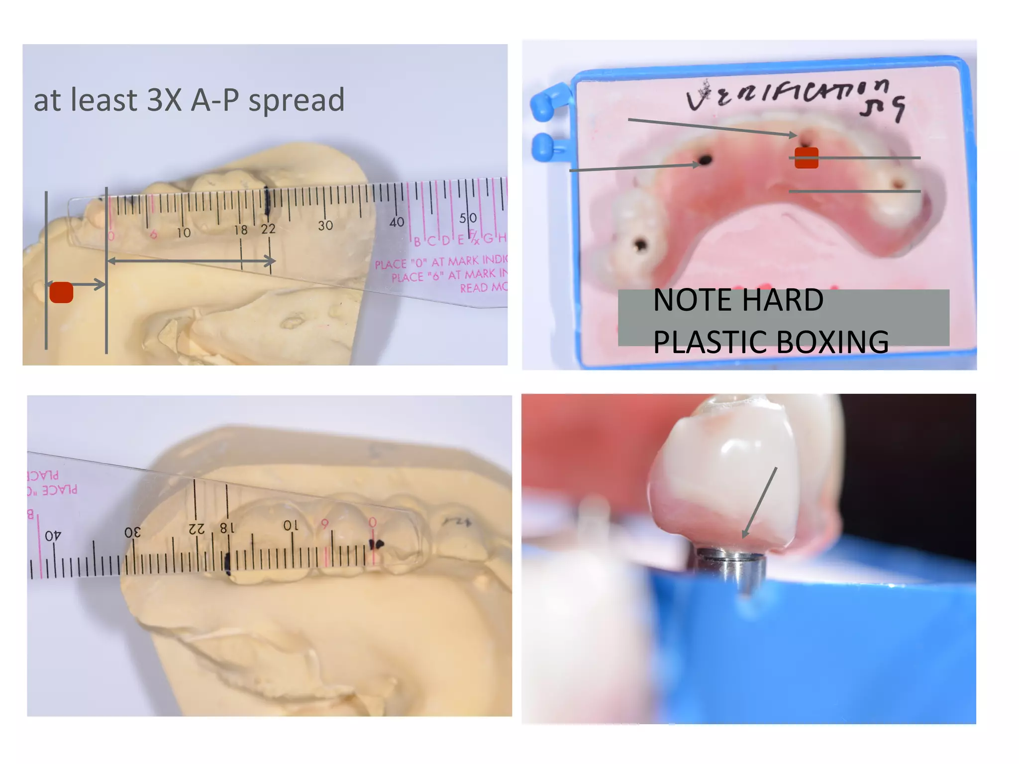 Prosthodontist's Tips for Full Arch Fixed Hybrid | PDF