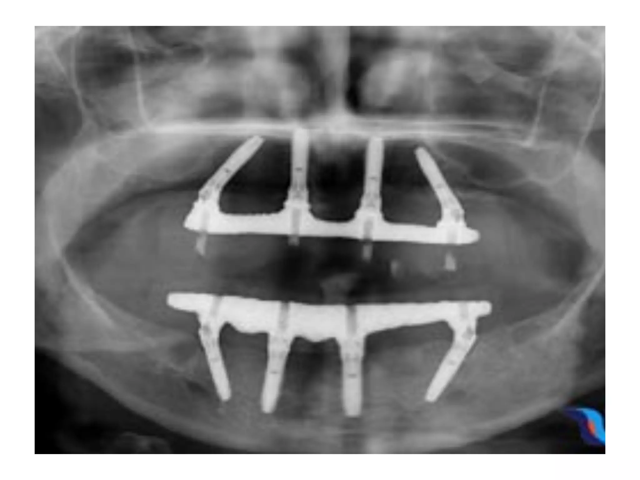 Prosthodontist's Tips for Full Arch Fixed Hybrid | PDF