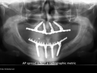 Prosthodontist's Tips for Full Arch Fixed Hybrid | PDF