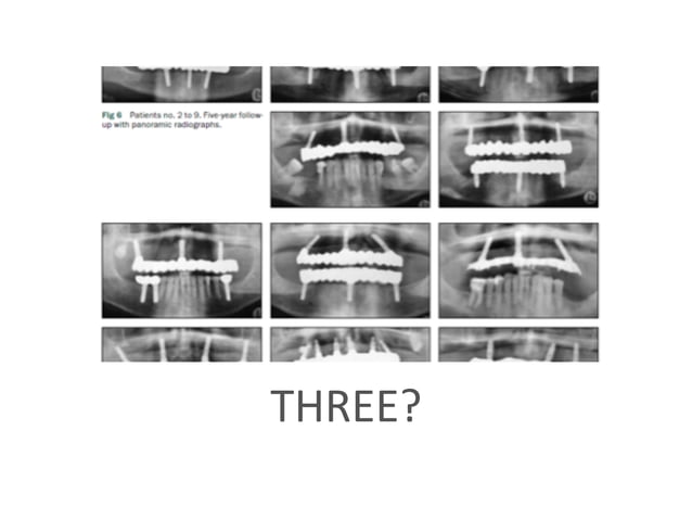 Prosthodontist's Tips for Full Arch Fixed Hybrid | PDF | Dental Health ...