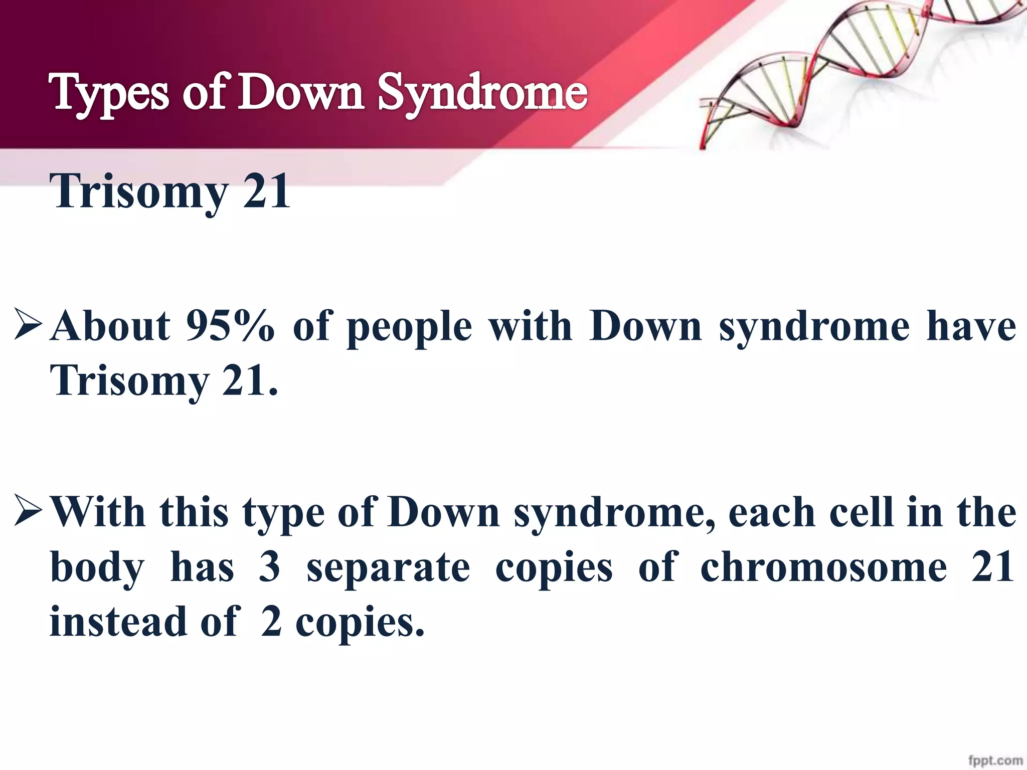 Down syndrome | PPTX
