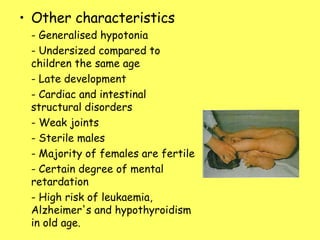 Down Syndrome Child | PPT | Genetics | Science