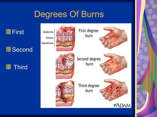 Burns causes , types , infections and management.ppt