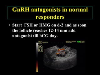 UNDERSTANDING DOWN REGULATION GnRH Agonists and Antagonists In ART | PDF