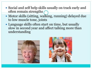 Downs syndrome | PPTX