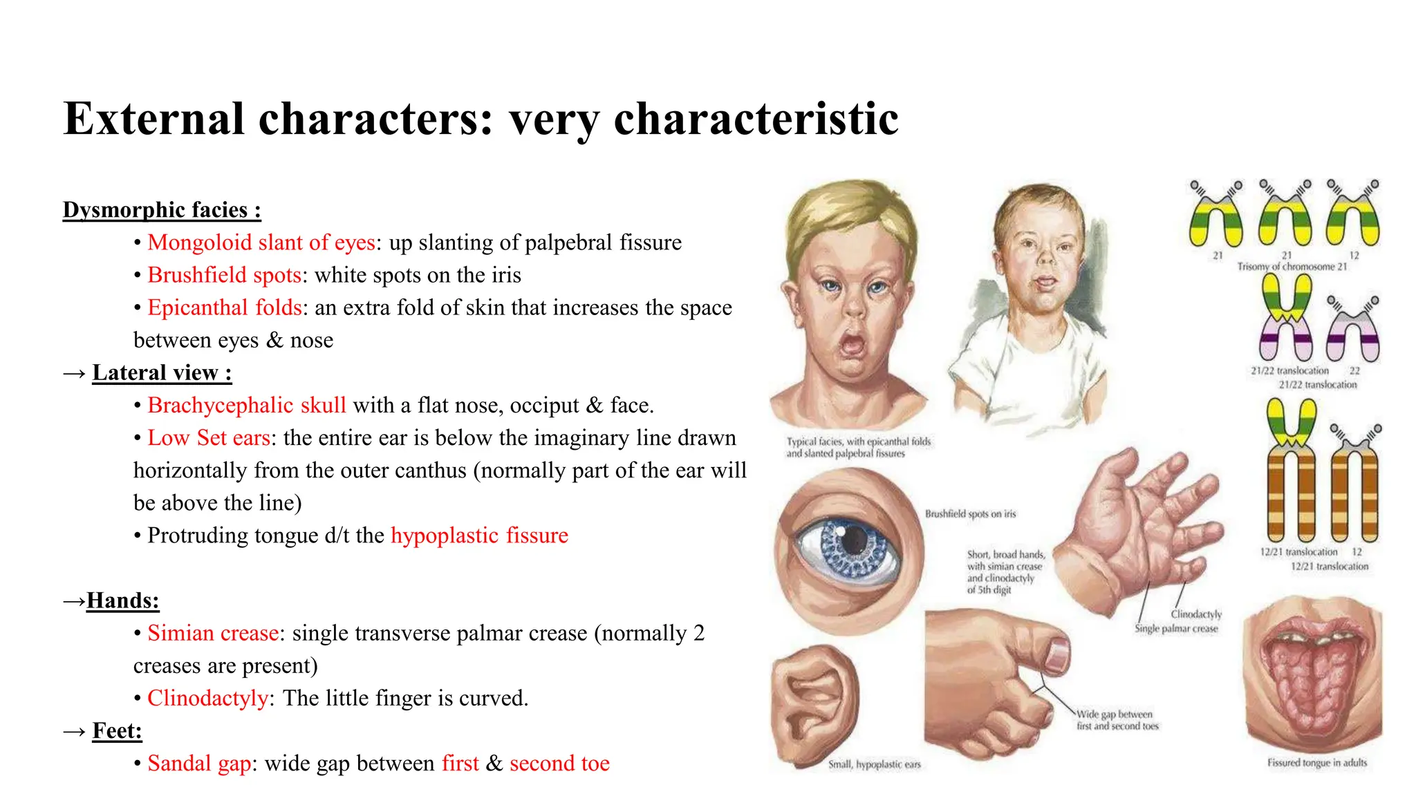 Down’s syndrome (Congenital disorders).pptx