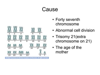 Down's syndrome lm | ODP